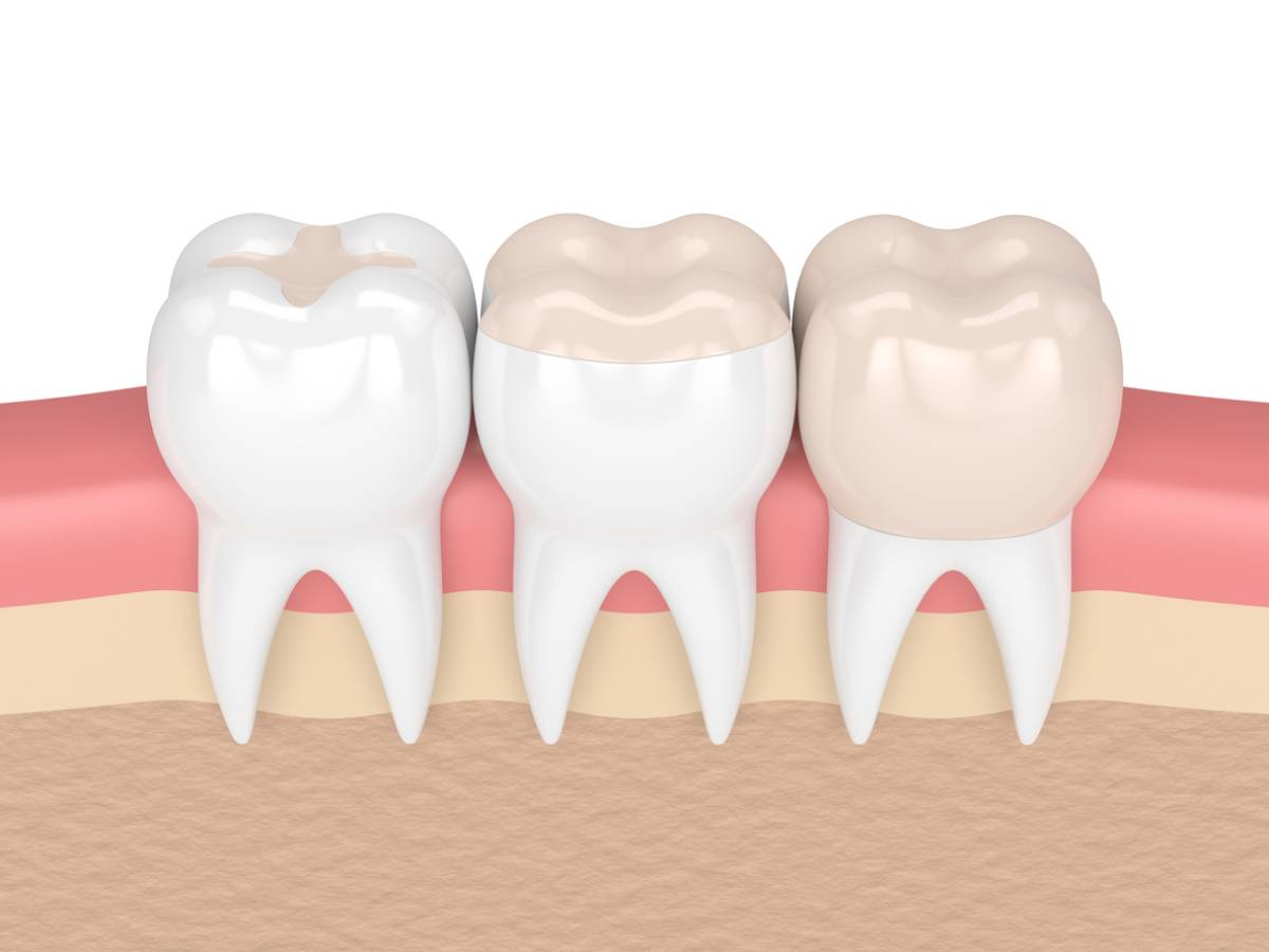 Aesthetic Fillings: What you Need to know? - Alfa