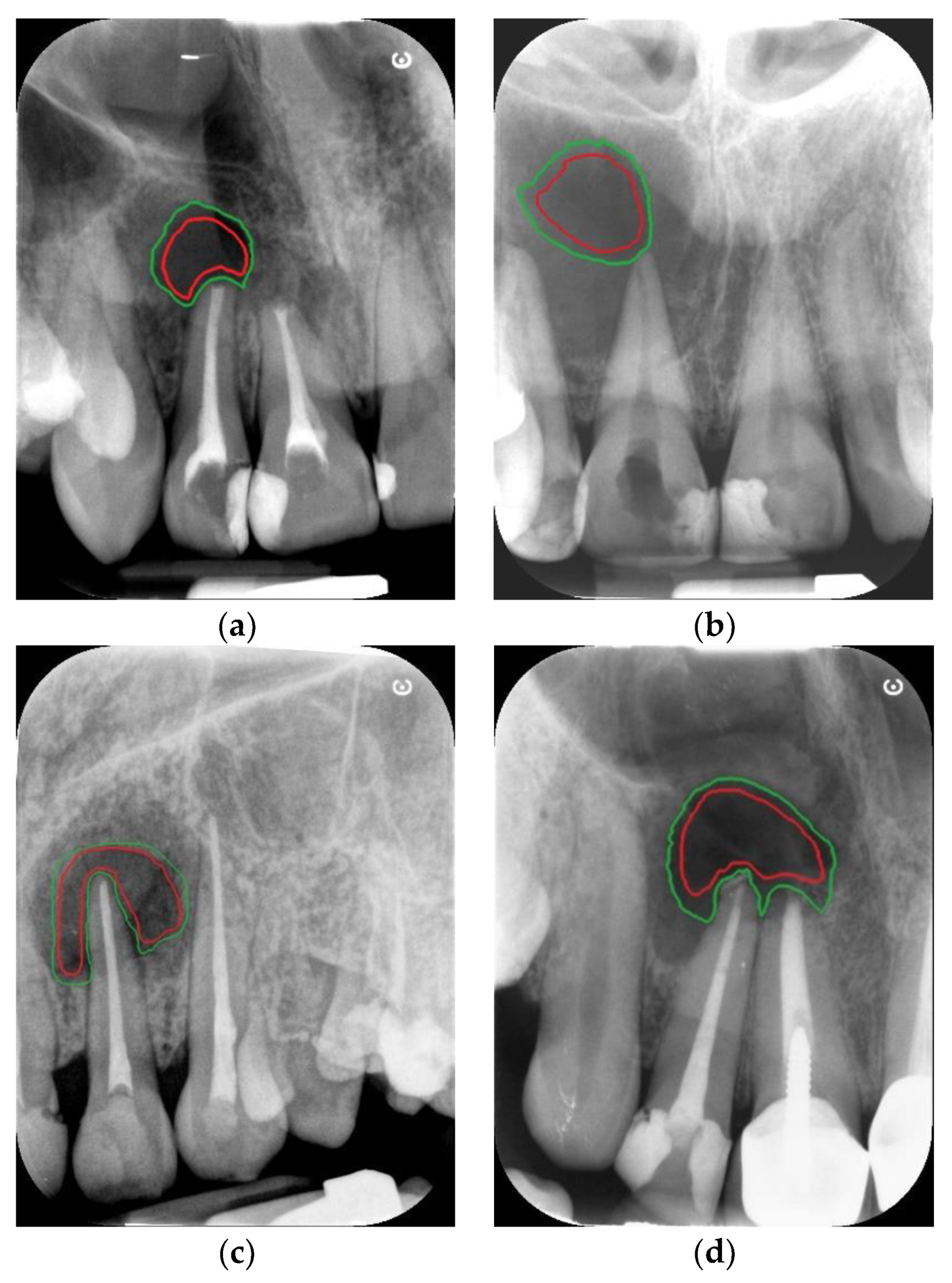 Cysts and Granulomas: What you Need to Know - Alfa
